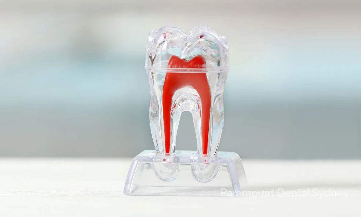 The Stages of Tooth Decay - Modbury Dental Practice